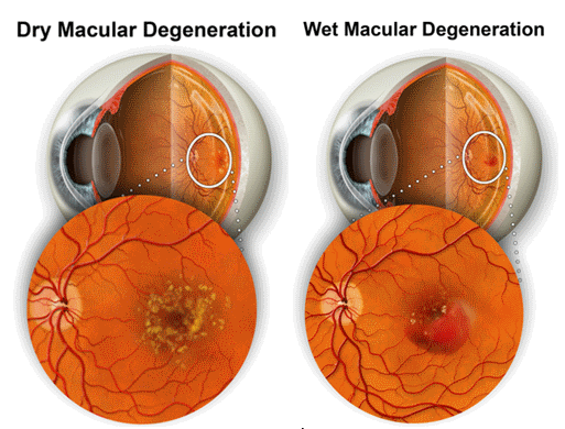 What Is Age Related Macular Degeneration Or AMD 