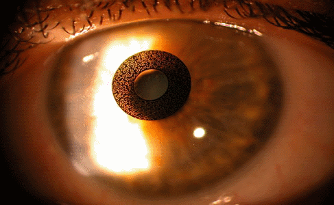 Corneal Inlays - Fraser Eye Care Center