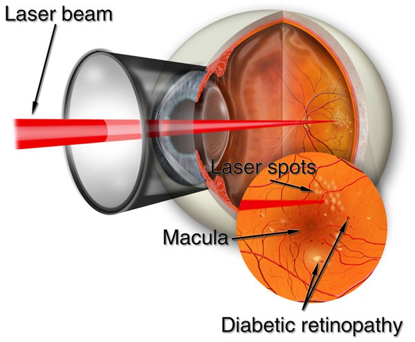 Diabetic Eye Disease - Fraser Eye Care Center