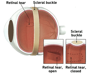 Retinal Detachment Detroit MI | Retinal Tear Treatment Michigan